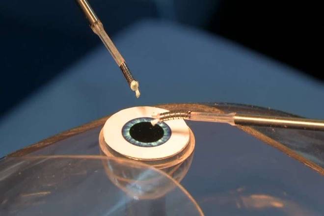 Robot performs delicate eye surgery on six patients - Life News | The ...