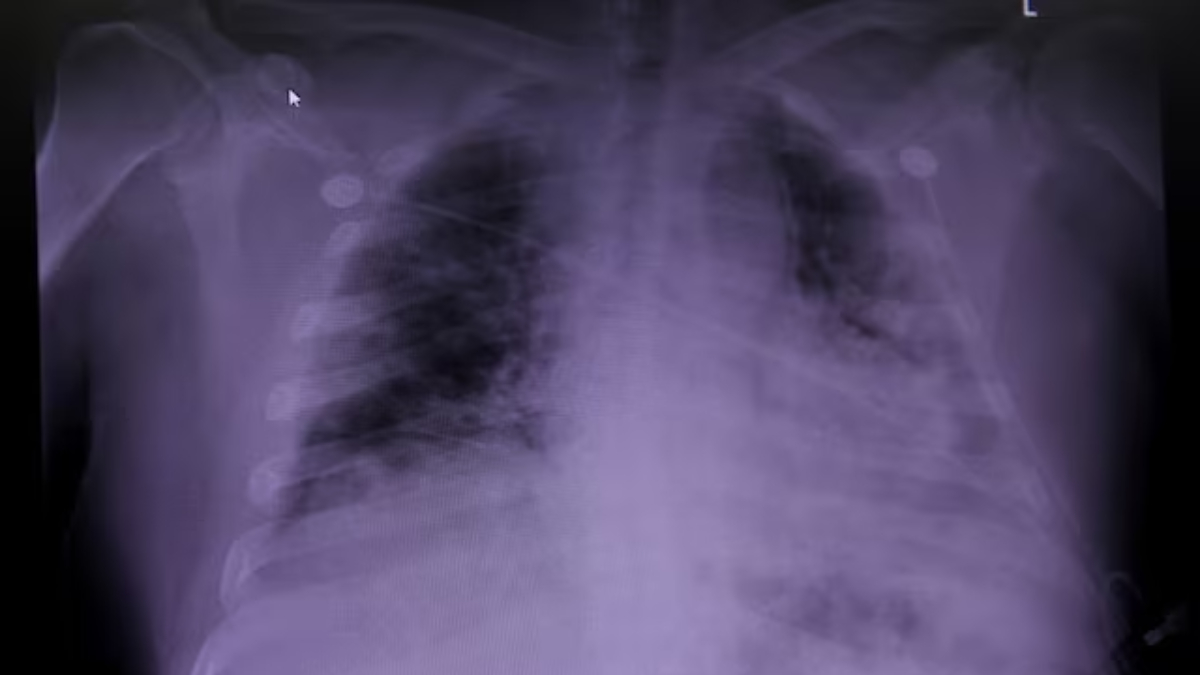 Idiopathic Pulmonary Fibrosis: All you need to know about the deadly disease behind Zakir ...